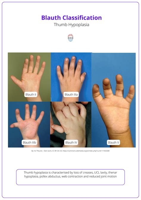 Thumb Hypoplasia Blauth Classification Diagnosis And Treatment