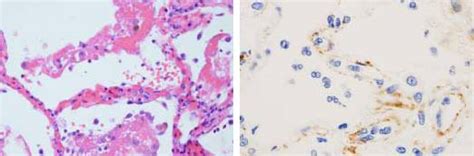 Does Sars Cov 2 Cause A Vascular Disease Fpm
