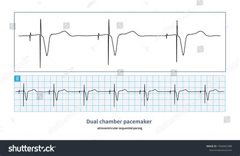 Sequential Atrioventricular Pacing Can Make Pacemaker Ilustrações Stock 1954062388 Shutterstock