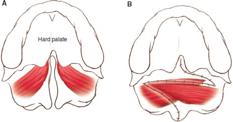 Correction Of Velopharyngeal Dysfunction By Double Opposing Z Plasty Plastic Surgery Key