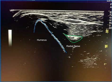 Ultrasound Guided Supracondylar Nerve Blocks For Reduction Of Distal Radius Fractures Emra