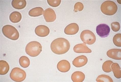 Macrocytosis Blood Cells Medical Laboratory Red Blood Cells