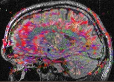 Diffusion Tensor Field Of An Healthy Patients Brain Directional Color
