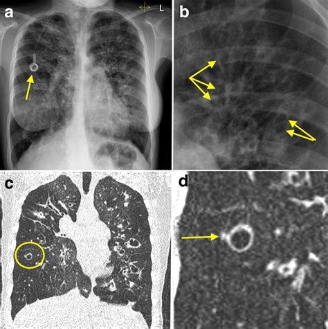 Chest X Ray Of Bronchiectasis At Louise Rizo Blog