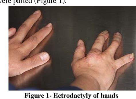 Figure 3 From Ectrodactyly Ectodermal Dysplasia Clefting Syndrome
