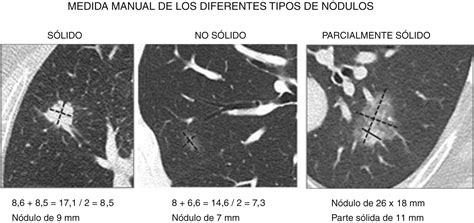 Nódulo Pulmonar Incidental Caracterización Y Manejo Radiología
