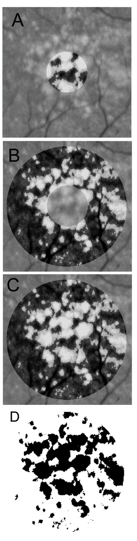 Drusen Segmentation In Central And Middle Subfields The Download Scientific Diagram