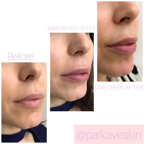 I Tried Lip Fillers For The First Timeheres Everything You Need To Know Before After Pics