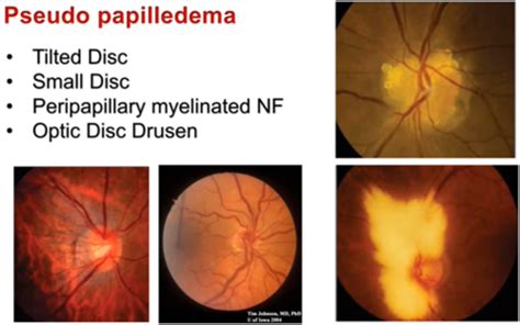 Papilloedema Flashcards Quizlet