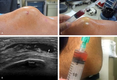 Septic Bursitis Treatment Guidelines At Lilly Minns Blog