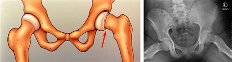 Slipped Capital Femoral Epiphysis Orthoinfo Aaos