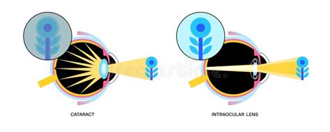 Intraocular Lenses Poster Stock Vector Illustration Of Vision 327678344