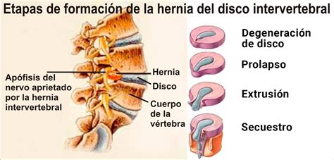 Hernia De Disco Intervertebral Hernia De Discodiscopatia Atlas