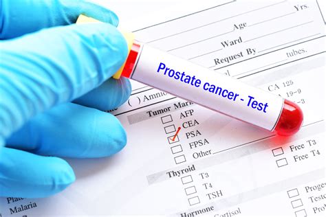 Prostate Cancer Diagnosed Via Ai