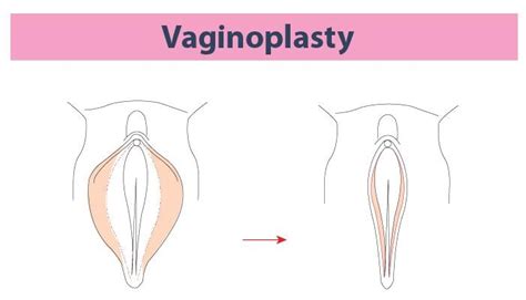 Vaginoplasty Surgery In Turkey
