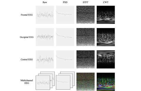 Example Of Raw 30 Second Electroencephalogram Electroencephalogram Download Scientific Diagram