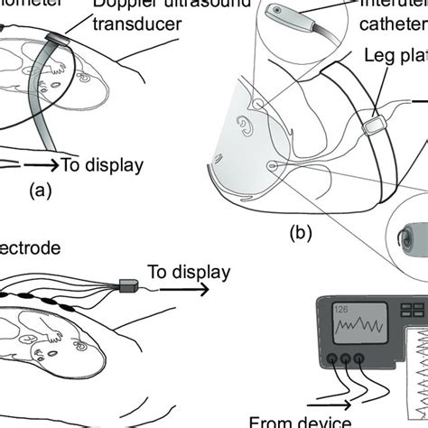 An Overview Of Fetal Monitoring Technologies For Capturing Fhr And Uc Download Scientific
