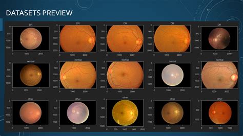 Diabetic Retinopathy Detection Using Cnn Architectures And Augmented Data Sets By Vishal Garg