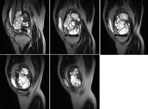 骨巨细胞瘤mri 骨囊肿和骨巨细胞瘤 伤感说说吧