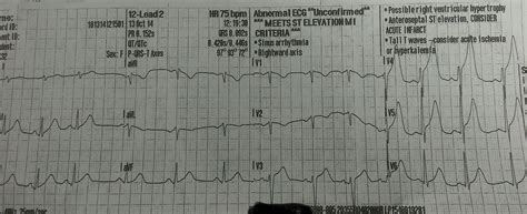 32 Yo F Lad Stemi Ekgs