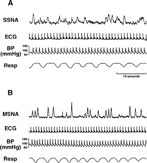 A Recordings Of Skin Sympathetic Nerve Activity Ssna Download Scientific Diagram