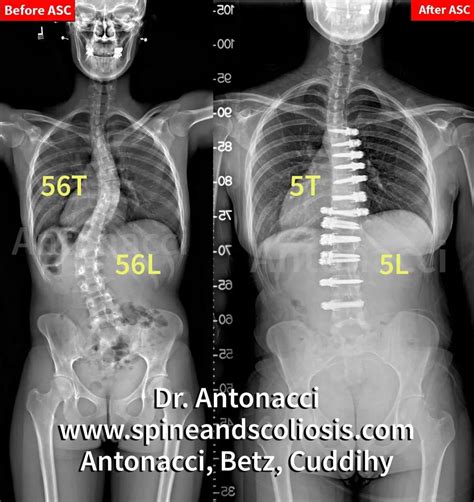 Sp 21yo Before After Asc Scoliosis Surgery Double Curve Institute