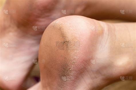 近距离观察脚后跟的鸡眼痂皮肤干燥问题