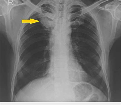 chest x ray showing nsclc lesion causing svc syndrome note a poorly download scientific