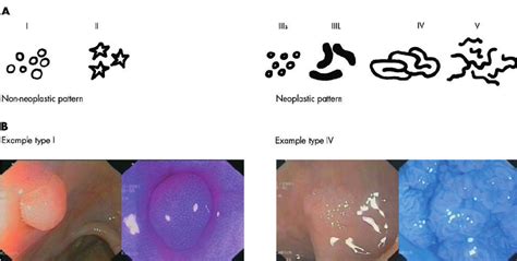 Pit Pattern Classification According To Kudo And Colleagues 16 The