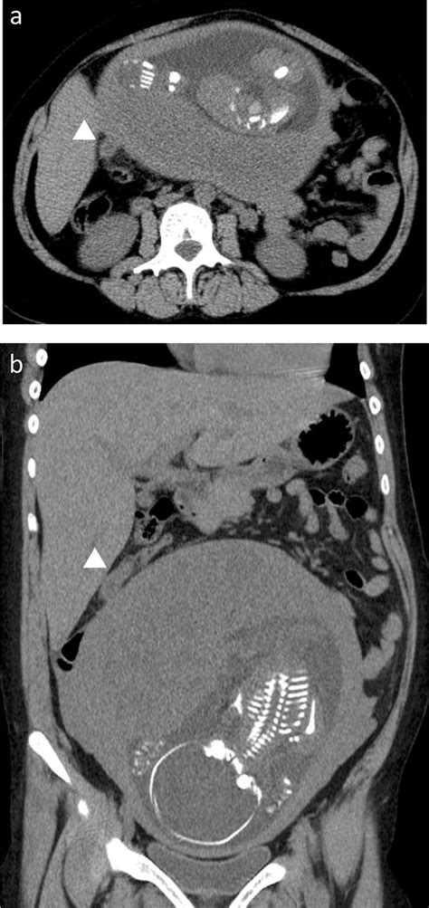 Preoperative Ct Scan The Swollen Appendix Arrows Was Translocated To Download Scientific