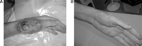 Figure 1 From Pyoderma Gangrenosum Associated With Inflammatory Bowel Disease Report Of Two