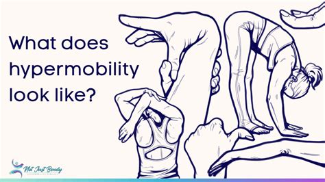 What Is Hypermobility Understanding Hsd And Heds