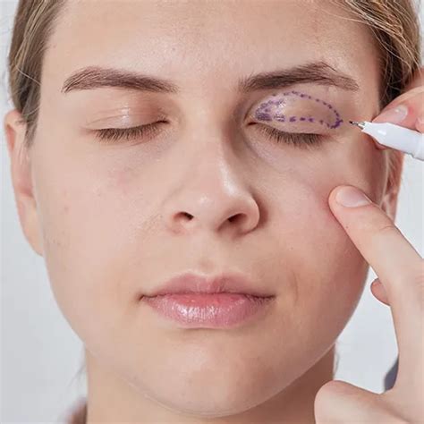 Cirurgia De Pálpebras Melhora Da Visão E Da Estética