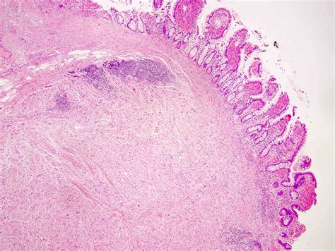 Granular Cell Tumor Tongue