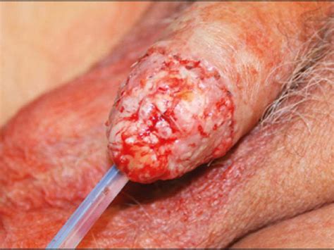 Completed Glansectomy With Split Skin Graft Notes Reproduced With Download Scientific Diagram