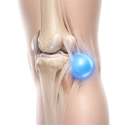 Bakers Cyst Symptoms And Treatment Spine And Orthopedic Specialists