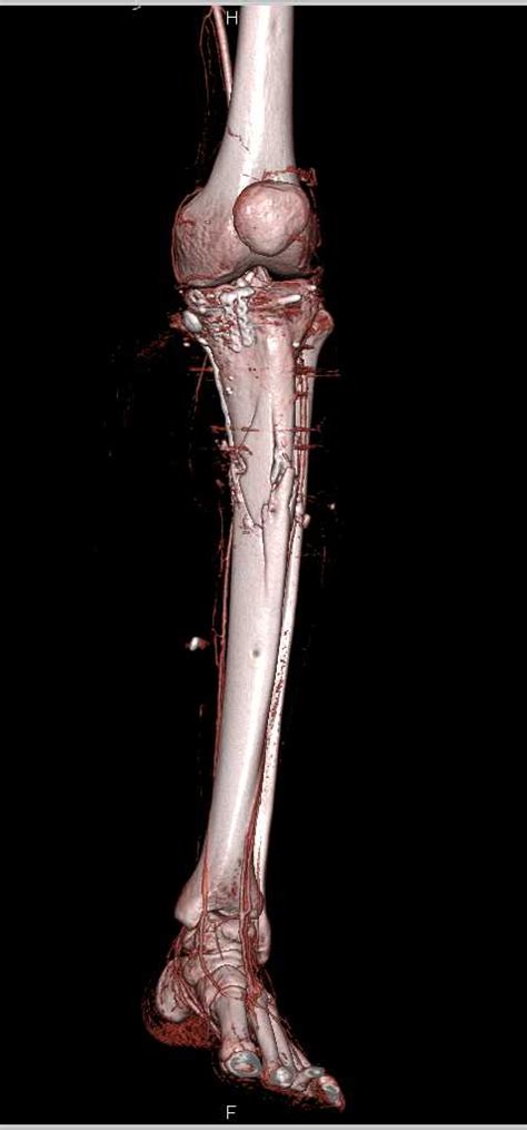 Comminuted Fracture Tibia Musculoskeletal Radiology Case Studies