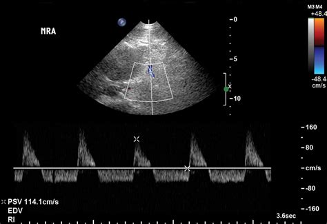 Abnormal Main Renal Artery Waveform