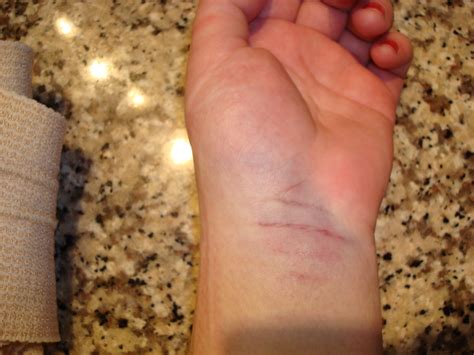 Sprained Wrist Bruising Wrist Sprain Symptoms Treatment In Dallas