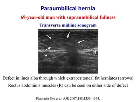 Ultrasound Of Groin And Anterior Abdominal Wall Hernias