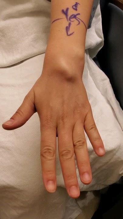 Yes This Is Extensor Tenosynovitis Of The 4th Compartment Some Hints… David R Miller Md