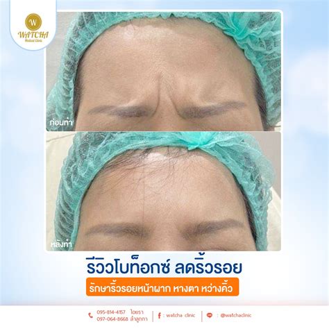 🤫 เคล็ดลับ ลดอายุ หน้าเด็กลงจนเพื่อนทัก 🤩 💉 โบลดริ้วรอย ไม่ว่าจะริ้วรอย 💢 ที่หน้าผาก ขมวดคิ้ว