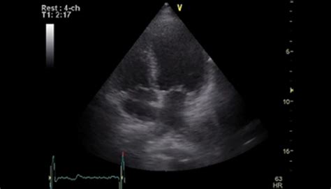Resting Echocardiogram Lved Volume 6940 Ml Ivs 125 Cm Lvidd