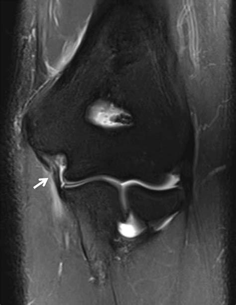 Coronal T2 Mr Arthrogram Of The Elbow Demonstrates A High Grade Partial Download Scientific