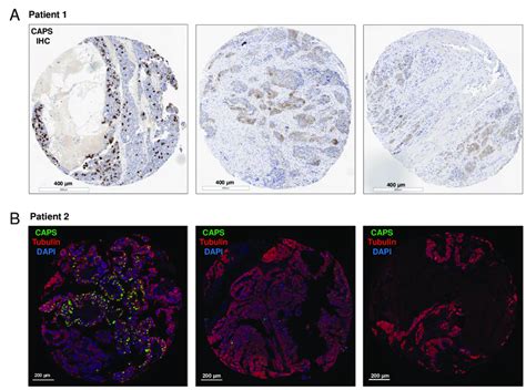 Detection Of Caps Cells In Primary Synchronous Metastatic And Download Scientific Diagram