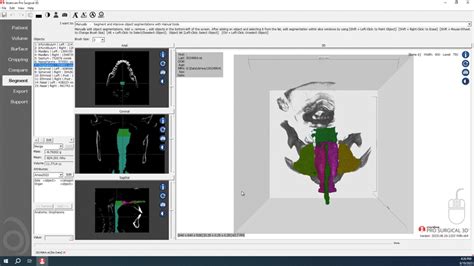 Human Airway Quality Assurance Review By Prosurgical3d