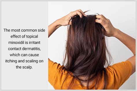 Minoxidil Shampoo Uses Contraindications And More