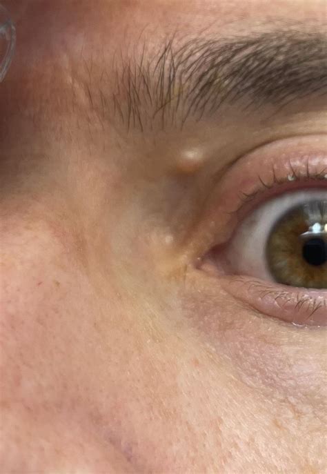 What Is This Bump On Top Of Eye Socket R Dermatologyquestions