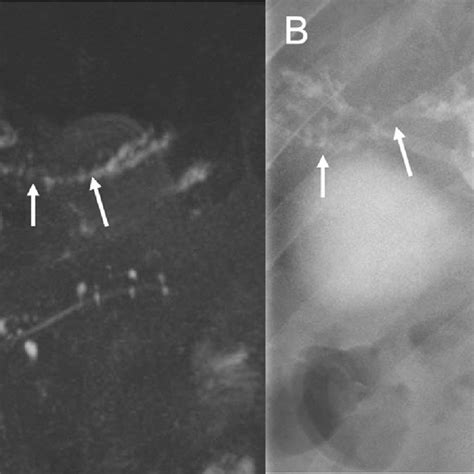 Aids Cholangiopathy In 24 Year Old Man With Longstanding Hiv Aids And A