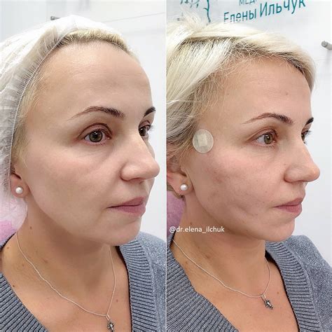 Нити для подтяжки лица 43 фото плюсы и минусы нитевой процедуры